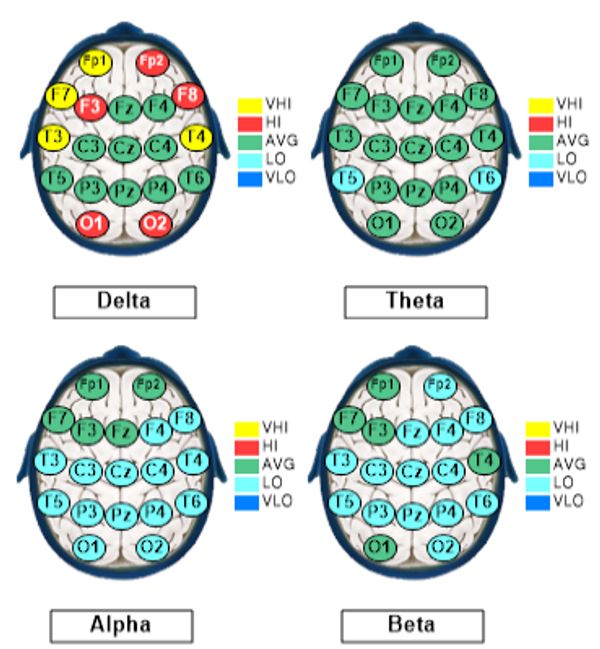 QEEG Brain Mapping